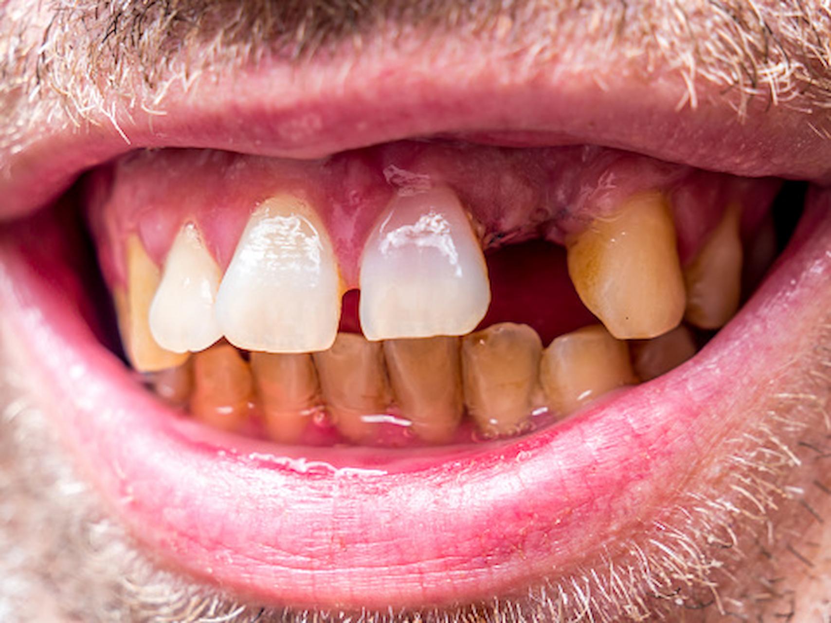 How Does Smoking Affect Your Mouth Choice USA Blog